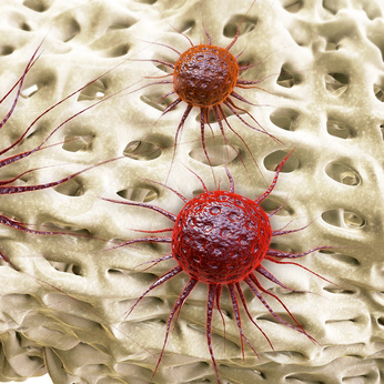 Knochenkrebs | CityPraxen Berlin