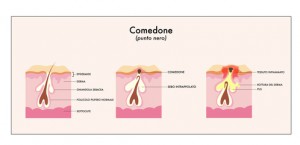 Akne vulgaris | CityPraxen Berlin